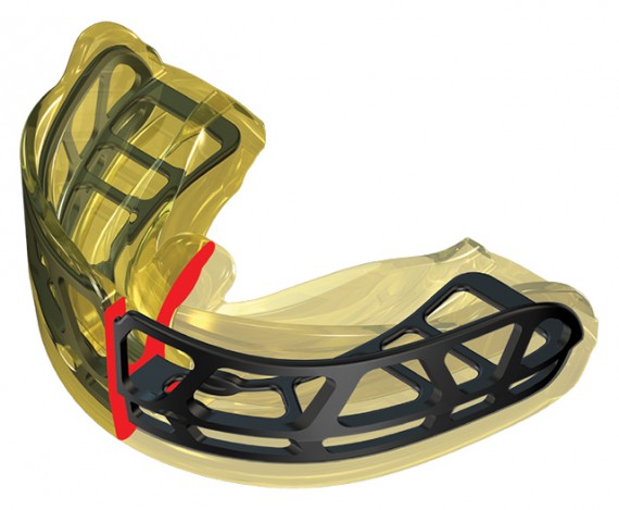 myobrace-interceptive-class-3 - Orthodeal